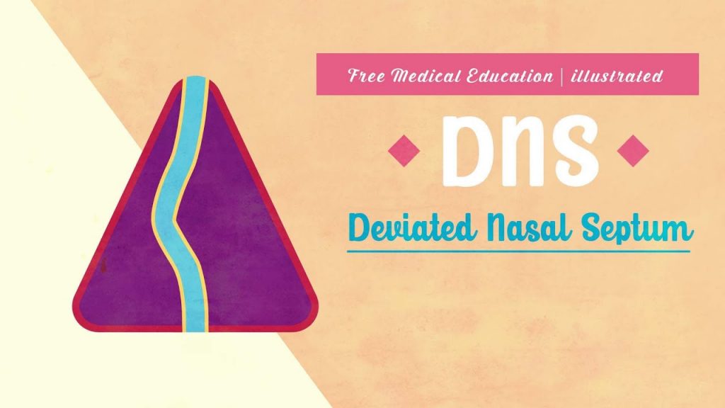 What is Deviated Nasal Septum (DNS)? – 4W1H Consultancy